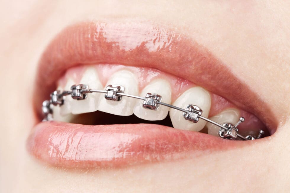 Do I Need Braces? 5 Reasons to Consider Them - Ferri Orthodontic ...